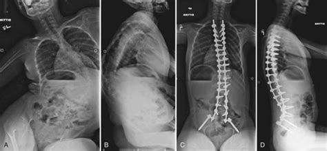Neuromuscular Scoliosis Musculoskeletal Key