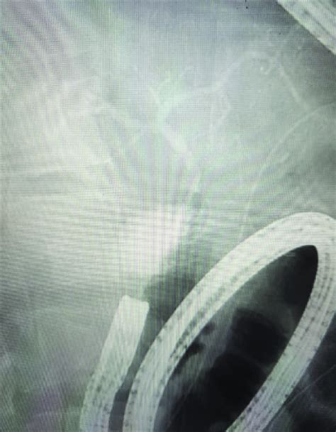 Postoperative Cholangiography Was Performed Using A Colonoscope After Download Scientific