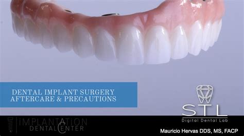 Dental Implant Surgery Aftercare · Implantation Dental Center