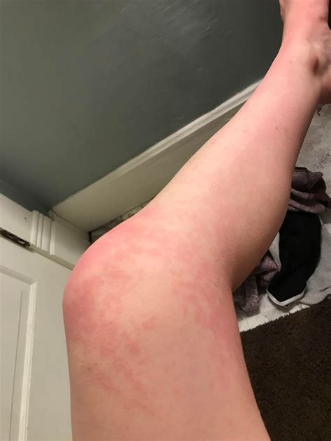 Heat Rash Knees