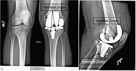 Incidence Of Osteolysis In Total Knee Arthroplasty The Journal Of