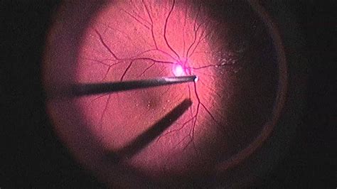 What Is Vitrectomy Hill Regional Hospital