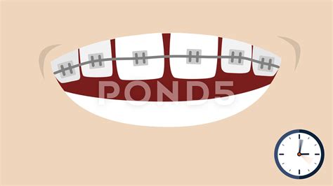 Smile With Braces Cartoon