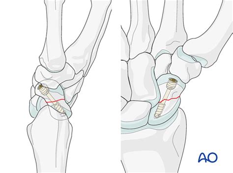 Orif Through Dorsal Approach Antegrade Screw Fixation For Scaphoid