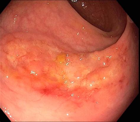 Solitary Rectal Mucosal Ulceration Discovered During Initial Screening