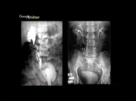 Infecciones De Riñones Rayos X El Cáncer De Células Renales Es Una