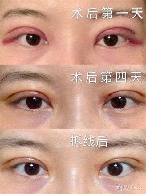 超详细的武汉割双眼皮的恢复记录案例医生分享！ 知乎