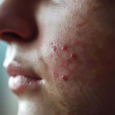 All You Need To Know About Pimples Pimple Lab®
