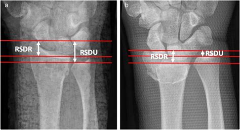 How Are Radial Height And Radial Shortening Defined In The Treatment Of