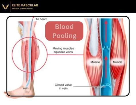 Blood Pooling In Athletes Causes Prevention And Care Elite Vascular