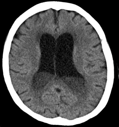 Brain Ct Scan Without Contrast Enhancement On Day 3 After Admission