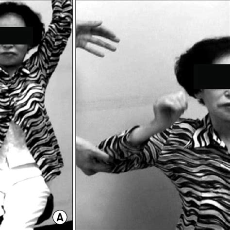 Pre Operative Clinical Photographs A Pseudoparalysis The Patient