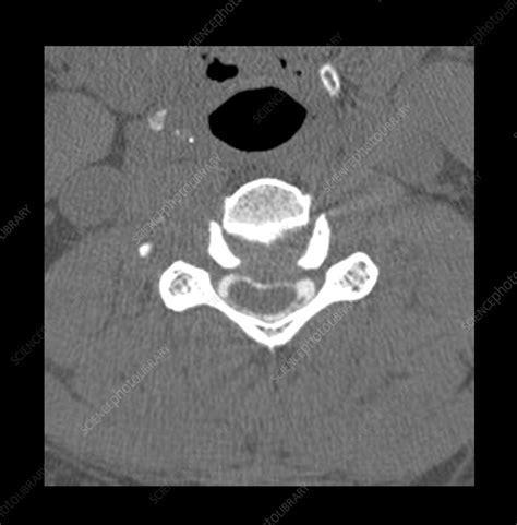 Cervical Myelogram Ct Stock Image C027 1644 Science Photo Library