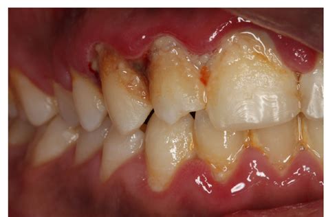 Necrotizing Ulcerative Gingivitis Necrotizing Ulcerative Gingivitis In