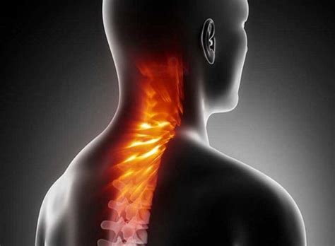 Ruptured Disc Treatment South County Spine Care Center