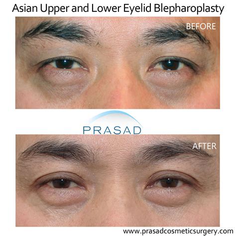 Double Eyelid Surgery Before And After Photos Dr Amiya Prasad