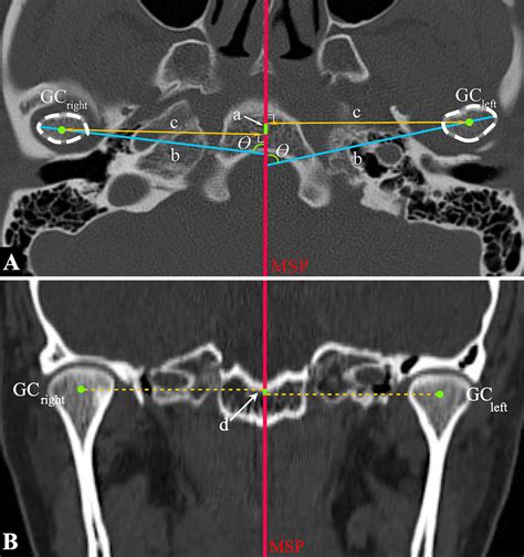 Positional Assessments Of The Condylar A Measurements Of The