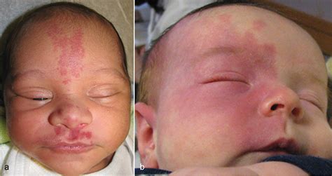 Classification Of Vascular Anomalies An Update Pmc