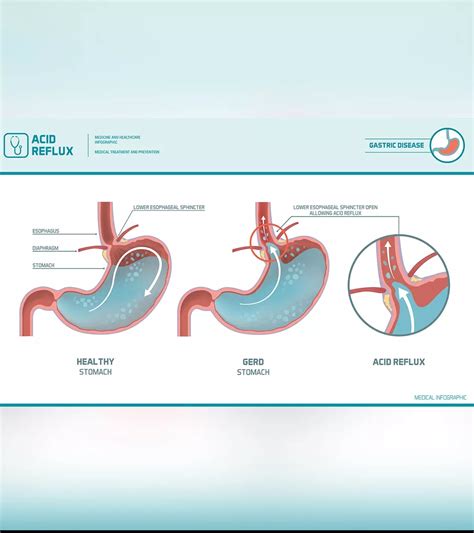 Acid Reflux Gerd In Teens Symptoms Causes And Treatments