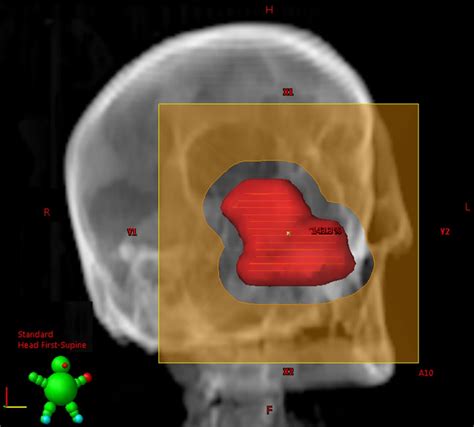 Wouter Crijns On Linkedin Journal Of Applied Clinical Medical Physics