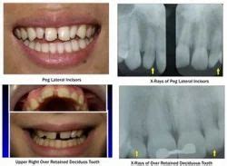Peg Lateral Treatment Services In New Delhi Id 16638154262