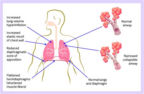 Pathophysiology Of Hyperinflation And Benefits Of Non Invasive Download Scientific Diagram