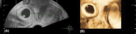 A 2d Ultrasound Showing Transverse View Of Unicornuate Uterus On Left
