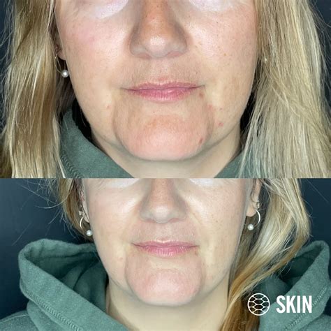 Oxygeneo Facial Treatment In Calgary Your Path To Radiant Skin