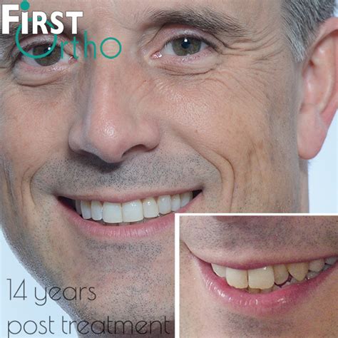Severe Crowding 14 Years After Braces First Ortho