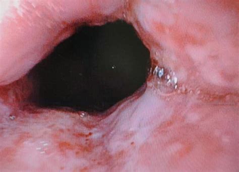 Upper Gastrointestinal Endoscopy Showing Group B Reflux Oesophagitis