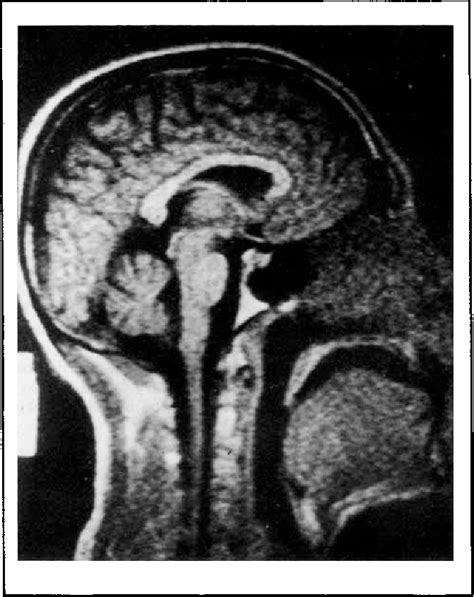 Figure 1 From Cerebral Dominance Sex And Callosal Size Inmri