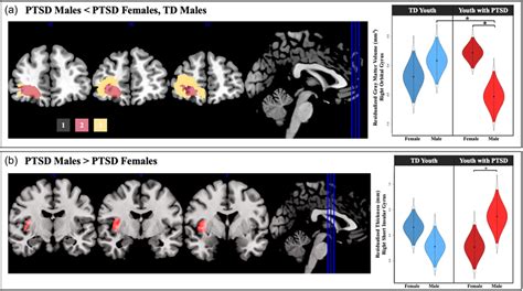 Sex‐based Variations In Brain Structure Among Youth With Posttraumatic