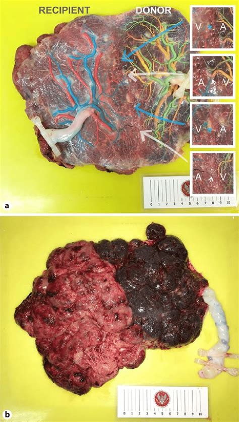 A Fetal Side Of The Placenta After Color Dye Injection Showing The Four Download Scientific