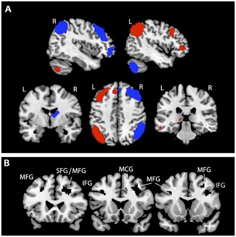 Aberrant Amygdala Functional Connectivity At Rest In Pediatric Anxiety