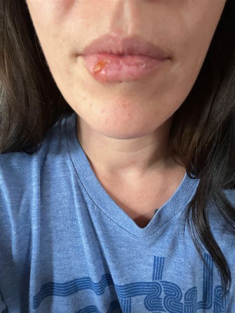 Exfoliative Cheilitis Rexfoliativecheilitis