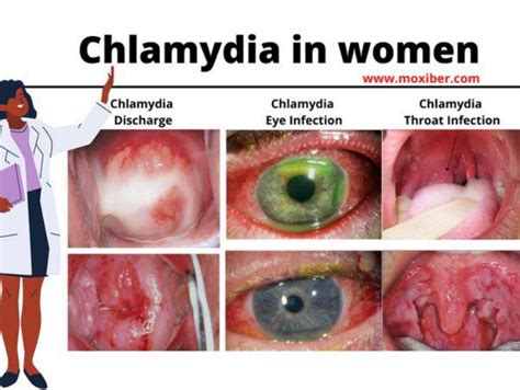 Chlamydia Flashcards