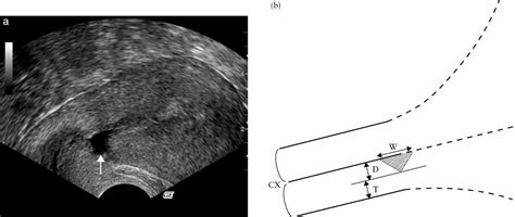Cesarean Scar Defect Correlation Between Cesarean Section Number