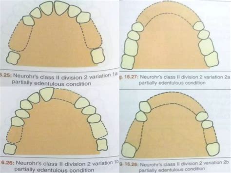 Introduction And Classification Of Removable Partial Denture Pptx