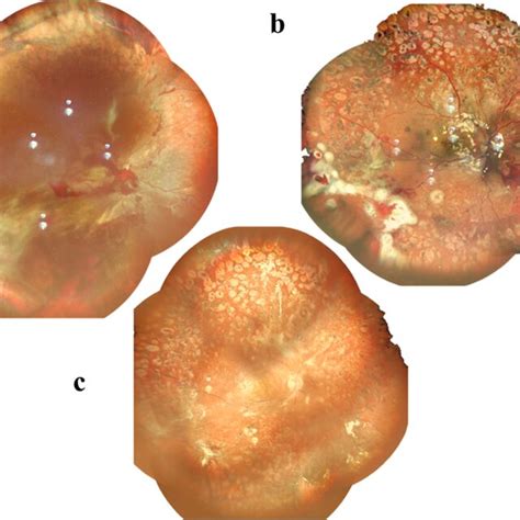 An Optical Coherence Tomography Image Of Erm And Fibrovascular