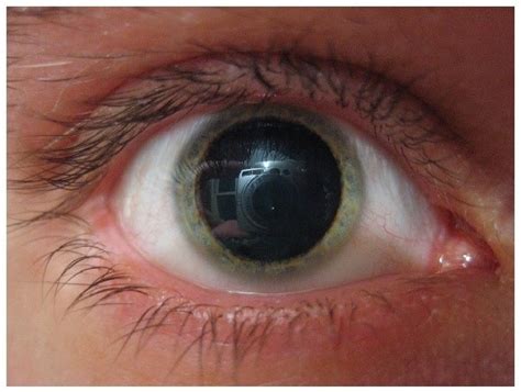 My Pupil Is Large And Dilated Dilated Pupils Causes