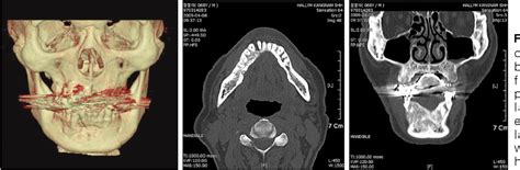 Figure 3 From Botryoid Odontogenic Cyst On Mandibular Anterior And Both