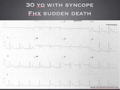 The Patient With Syncope Ecg Quiz Resus