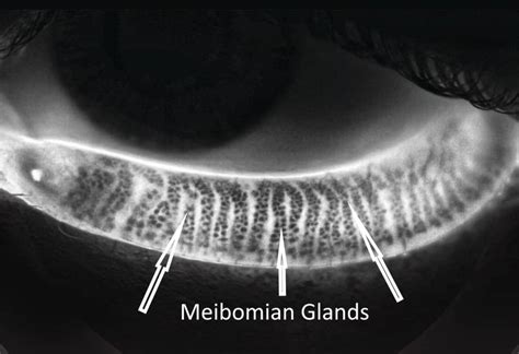 Meibomian Gland Dysfunction Mgd Eye Health Clinic Treatment