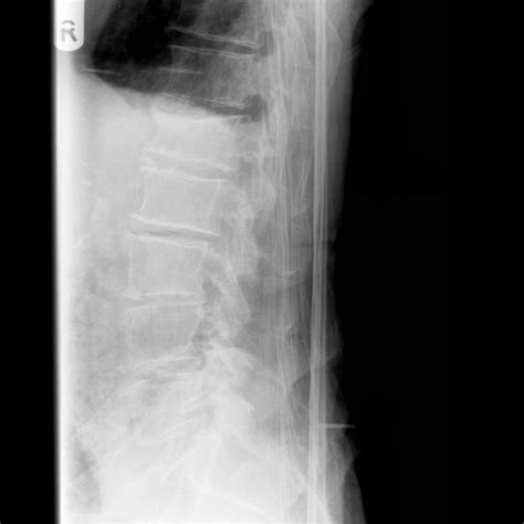 Wedge In Spine