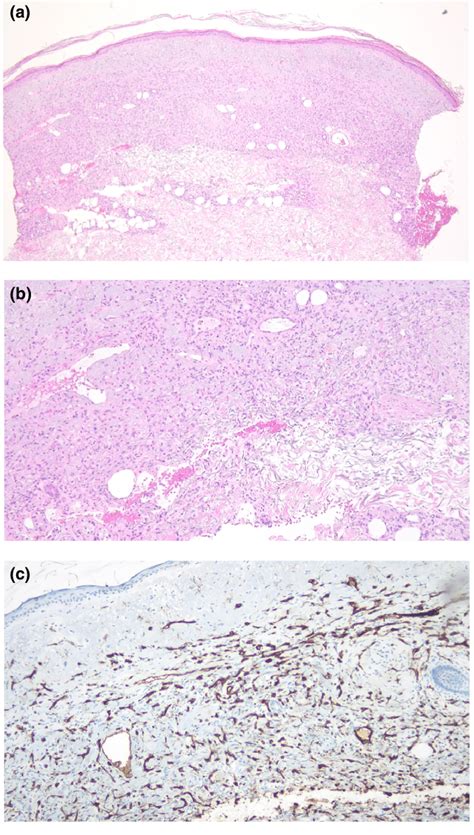 A Diffuse Band Like Vascular Proliferation Predominantly Located