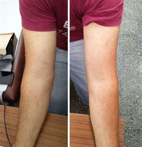 Phytophotodermatitis Still A Poorly Recognised Diagnosis Bmj Case