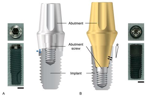 Prosthesis Free Full Text Influence Of Implant Abutment Connection