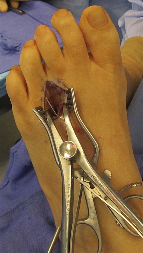 Interdigital Neuralgia Foot And Ankle Clinics