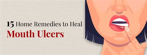 Mouth Ulcers Causes Symptoms And Treatments Rela Hospital