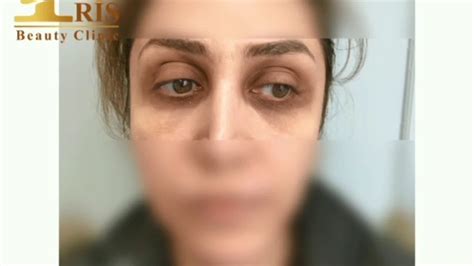 درمان قطعی گودی و تیرگی زیر چشم در مرکز زیبایی آیریس نماشا